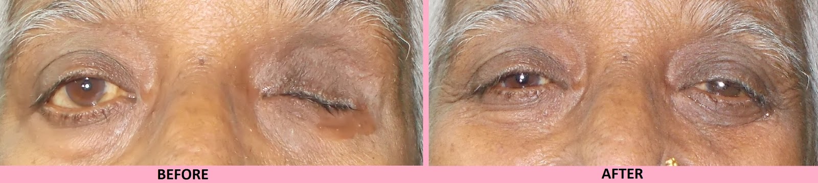 Asian Ocularist: Pros and Cons of an Ocular Prosthesis or an artificial ...