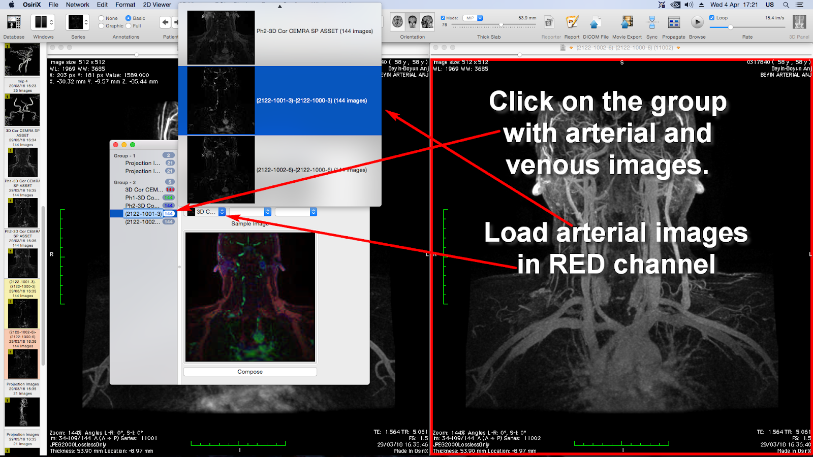 Nevit's blog: How to Create Color MR Angiography using Osirix and Color ...