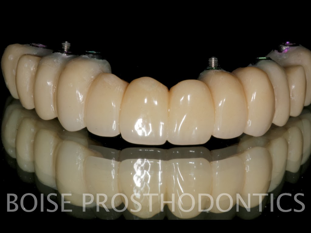 Boise Idaho Prosthodontics: Maxillary Implant Rehab Provisional, Index ...