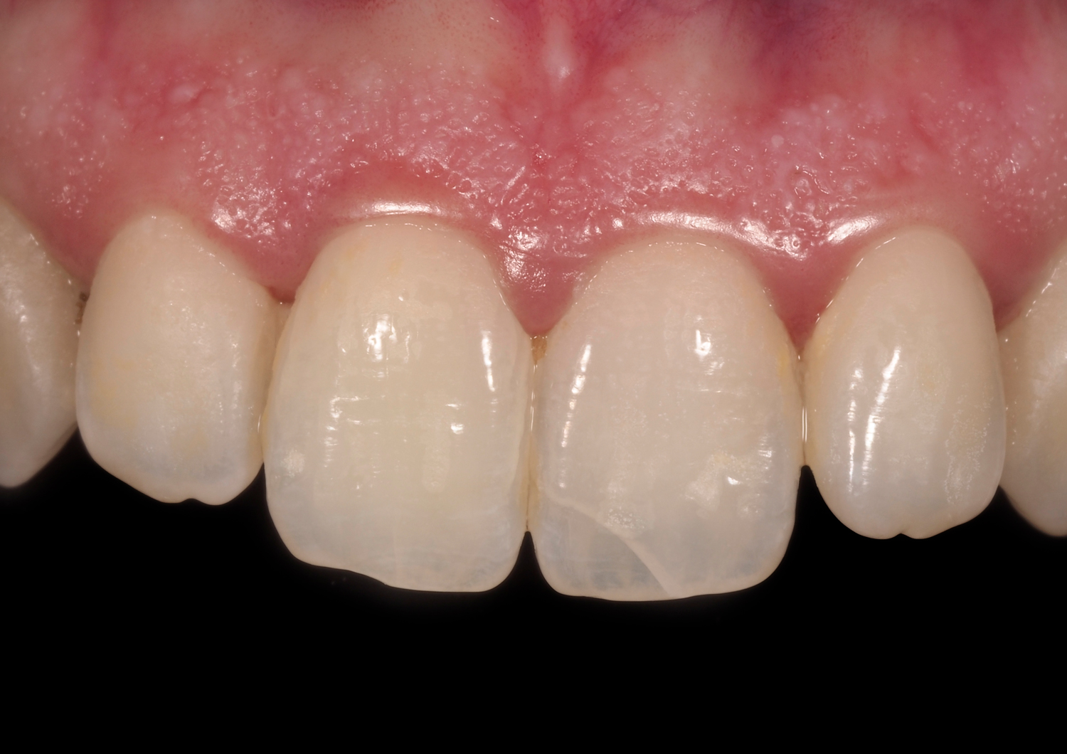 TRATAMIENTO DE CONDUCTOS: 1.1 calcificado. Blanqueamiento interno