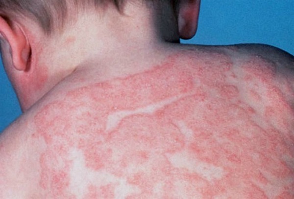 Child Psoriasis Treatment | Psoriasis Treatment for Child!