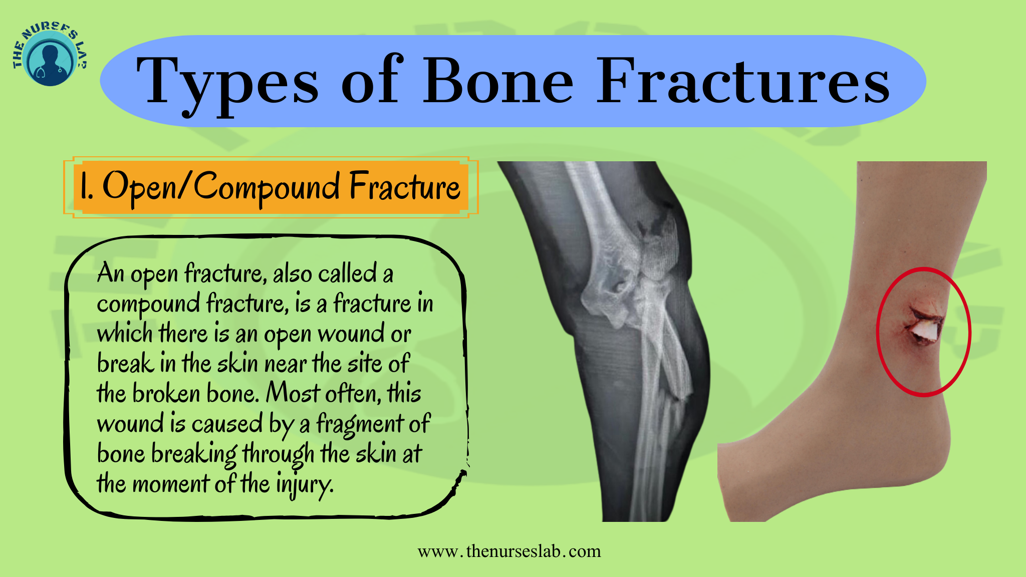 Types of Bone Fracture