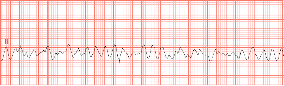 Basic EKG Test 71