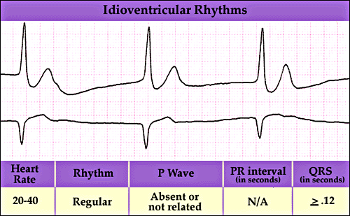 Idioventricular Rhythm | INA - ECG
