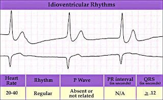 Idioventricular Rhythm | INA - ECG
