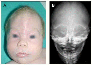 EL CLUB DE BLANCO: Malformaciones y deformaciones craneales.