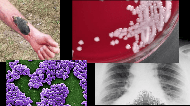 Hla Oo's Blog: 1979 Anthrax Leak In Sverdlovsk, Soviet Union