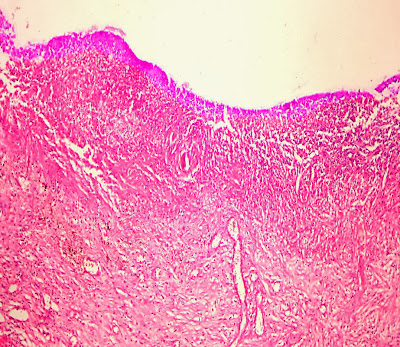 10. Fibrinoidna necrosis (bottom of a stomach ulcer). | Pathology