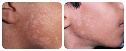 Penyebab dan 2 Cara Paling Cepat Menghilangkan Panu di Wajah - County Food