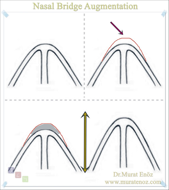 Nose Root Augmentation With Underskin Tissue For Flat Ethnic Nose ...