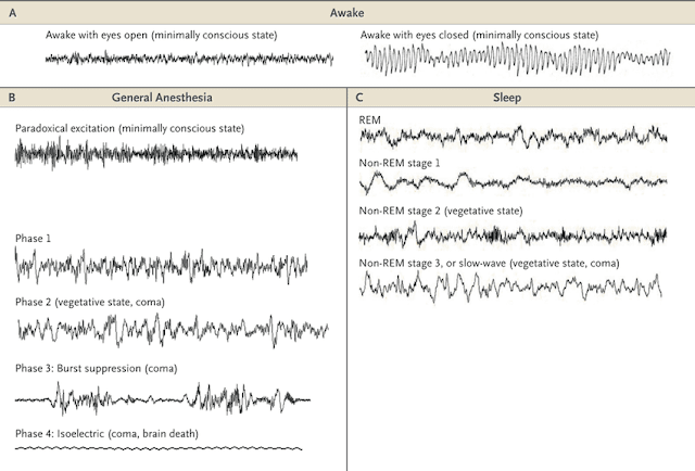 Montclair High School Bio Blog: The Science Behind Comas