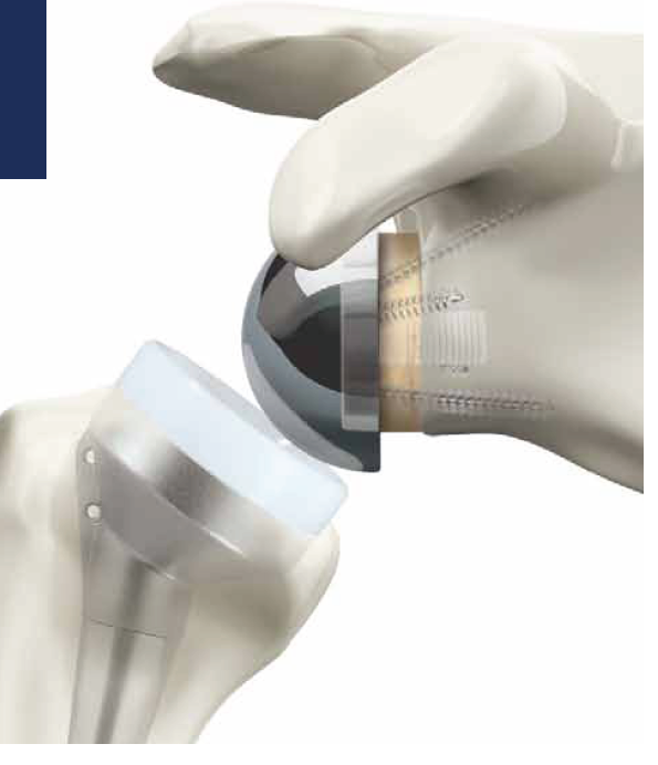 UW Shoulder and Elbow Academy: Reverse total shoulder - is an eccentric ...