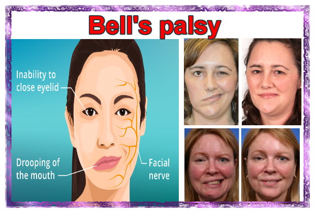 Bell's palsy | Sure Shahbaz Khan Sir