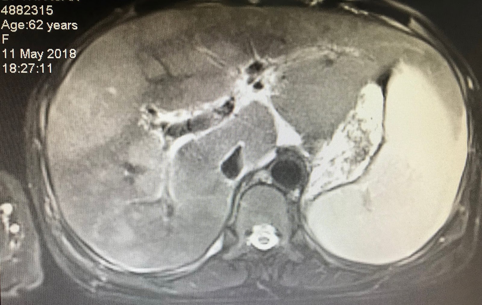 VIETNAMESE MEDIC ULTRASOUND: CASE 494: PRIMARY LIVER LYMPHOMA (PLL),Dr ...