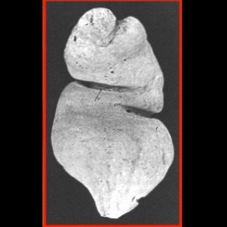 Did you know ???: 5 MOST CRAZIEST FOREIGN OBJECTS FOUND STUCK IN A RECTUM