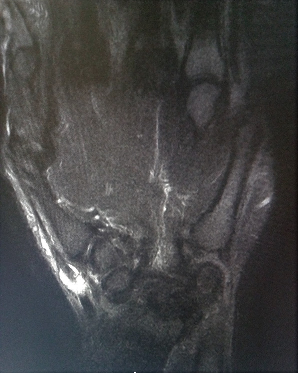 De Quervain Tenosynovitis: MRI - Sumer's Radiology Blog