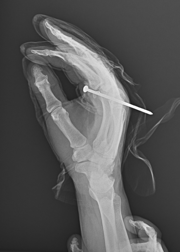 Traumatólogo de Guardia - Pedro Larrauri - Vigo.: Clavo atravesando la ...