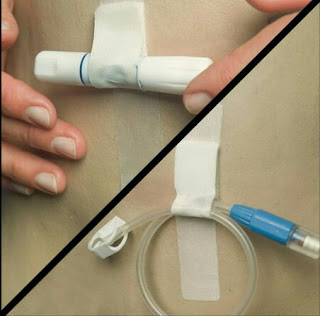 CAPD, Gagal Ginjal (Rawat home care CAPD)