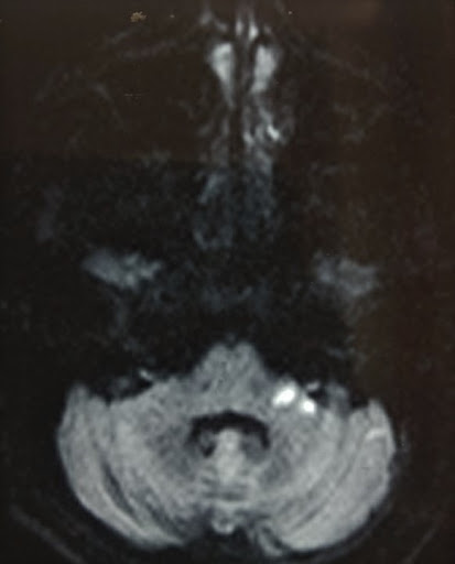 AICA Territory Infarct - Sumer's Radiology Blog