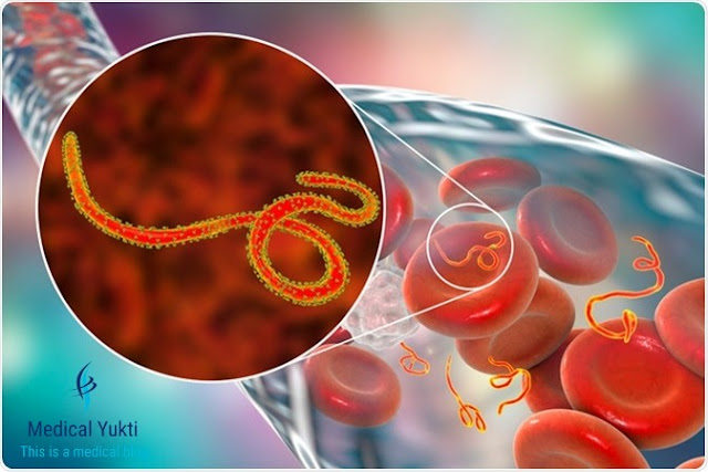 Ebola Virus Disease (EVD) - Medical Yukti