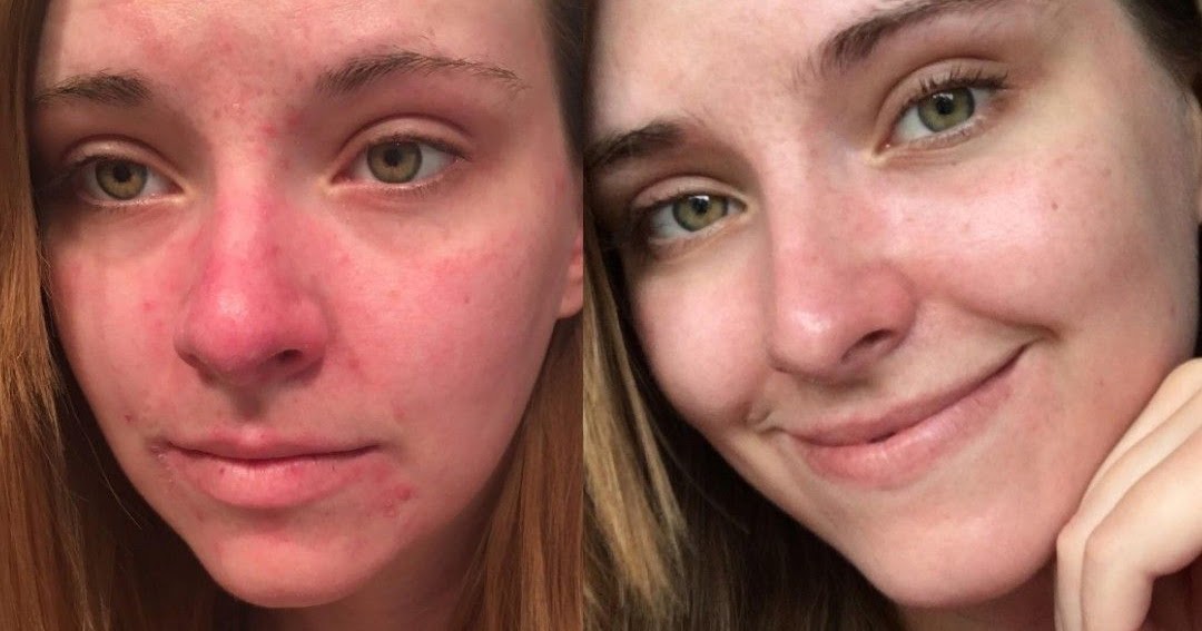 Remèdes naturels pour faire disparaître les rougeurs du visage