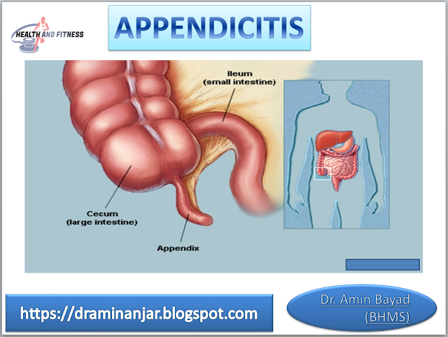 HEALTH AND FITNESS: What is appendicitis ? | causes, symptoms, and ...