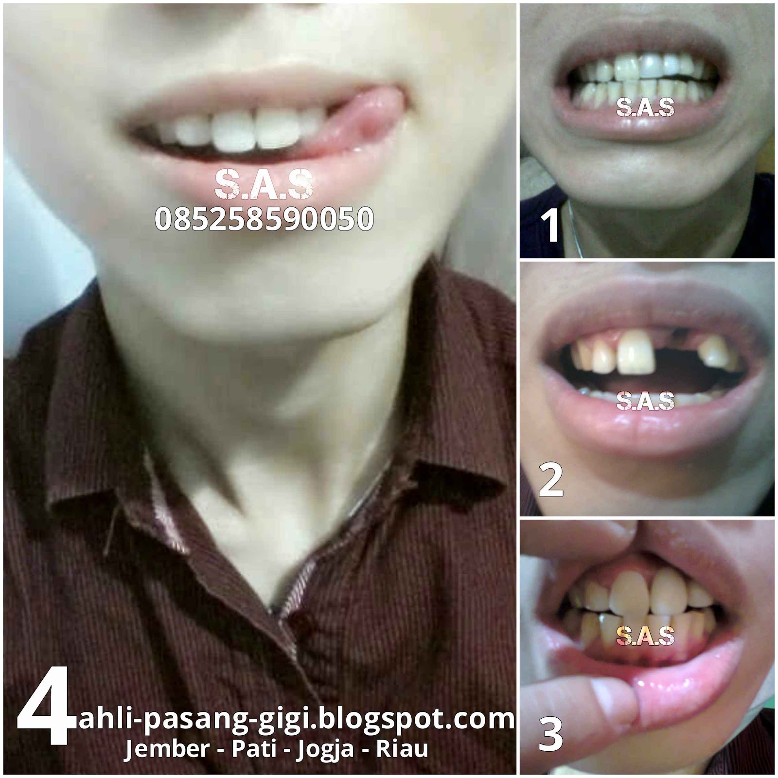 Foto Contoh Pemasangan Gigi Tiruan dan Merapikan Gigi