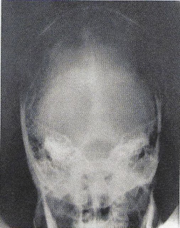 Sahabat Afterego: Prosedur Pemeriksaan Radiograf Cranium