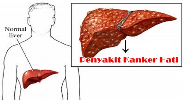 Obat alami untuk liver kankerhati bengkak hepatitis