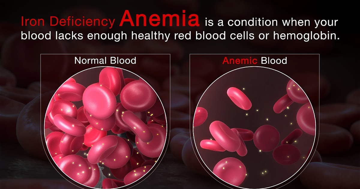 Iron Deficiency Treatment