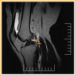 O'Donoghue's unhappy triad -MRI - Sumer's Radiology Blog