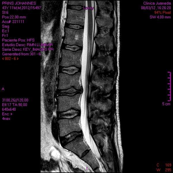 Prinsen en Prinsessen: Hernia en mijn MRI scan