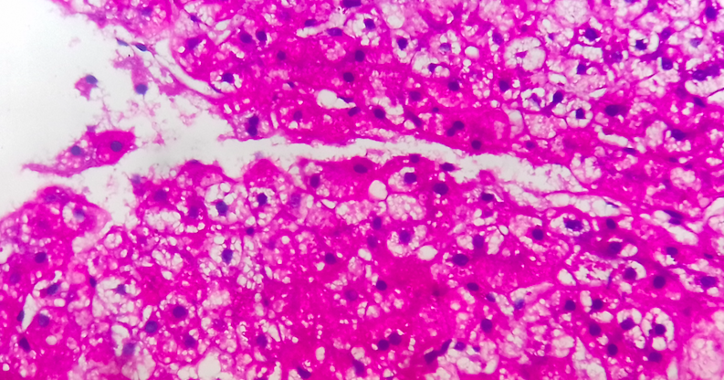 KIMAN - Making pathology simple!!: Periodic Acid Schiff (PAS) staining