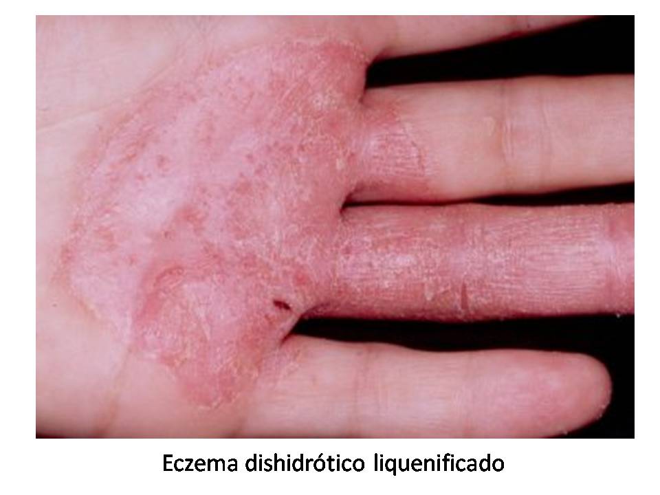 Eccema Dishidrótico; Eccema Vesicular Palmoplantar; Ponfólix