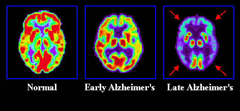 IB Psychology: Alzheimer's Disease: The Forgetting