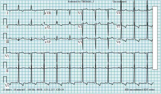 Non-ST-Segment Elevation Myocardial Infarction (NSTEMI) Case File