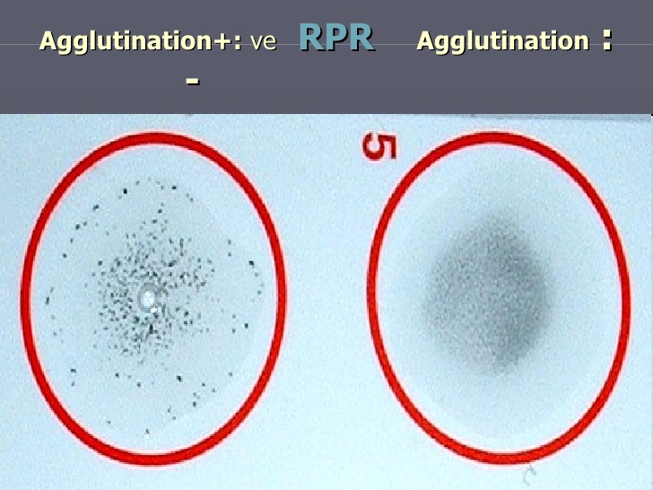 Resep Dokter Untuk Vdrl Dan Tpha Positif Sifilis | Solusi Herbal De ...