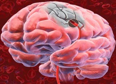 Apoplexia Hipofisária Tratamento e Diagnostico