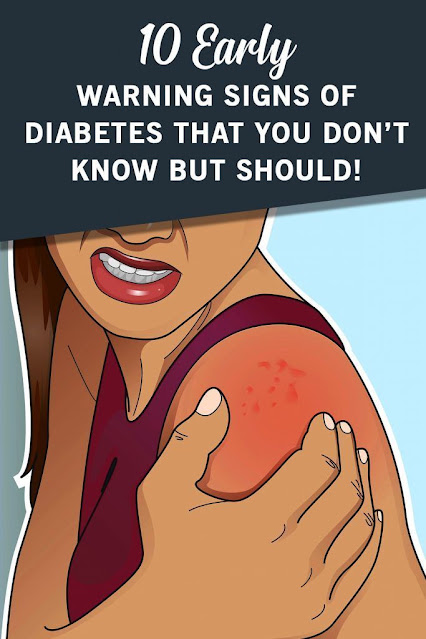 10 Early Warning Signs Of Diabetes Everyone Should Know! - wellness days
