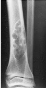 Fibrous cortical defect - Radiology Imaging