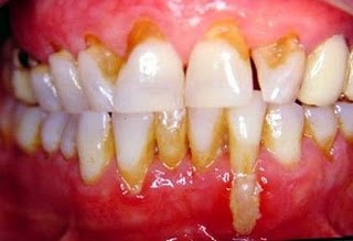 Clinica Dentis Implant: ¿Qué es el sarro? Tratamientos para prevenir el ...