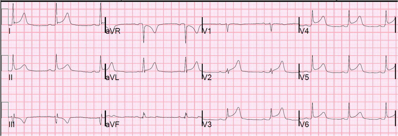 Dr. Smith's ECG Blog: Pericarditis, or Anterior STEMI? The QRS proves it.