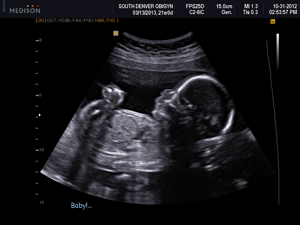 A Road Well Traveled: Anatomy Scan- 21 weeks!