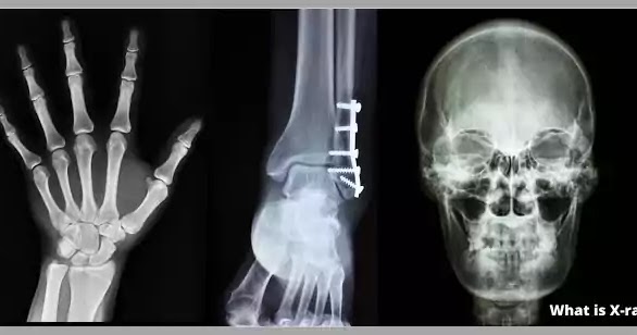 What is X-ray? Explained