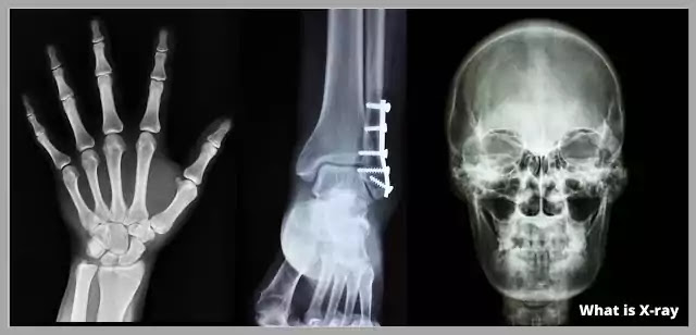 What is X-ray? Explained