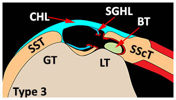 MRI Musculo-Skeletal Section: Long head of biceps dislocation grading.