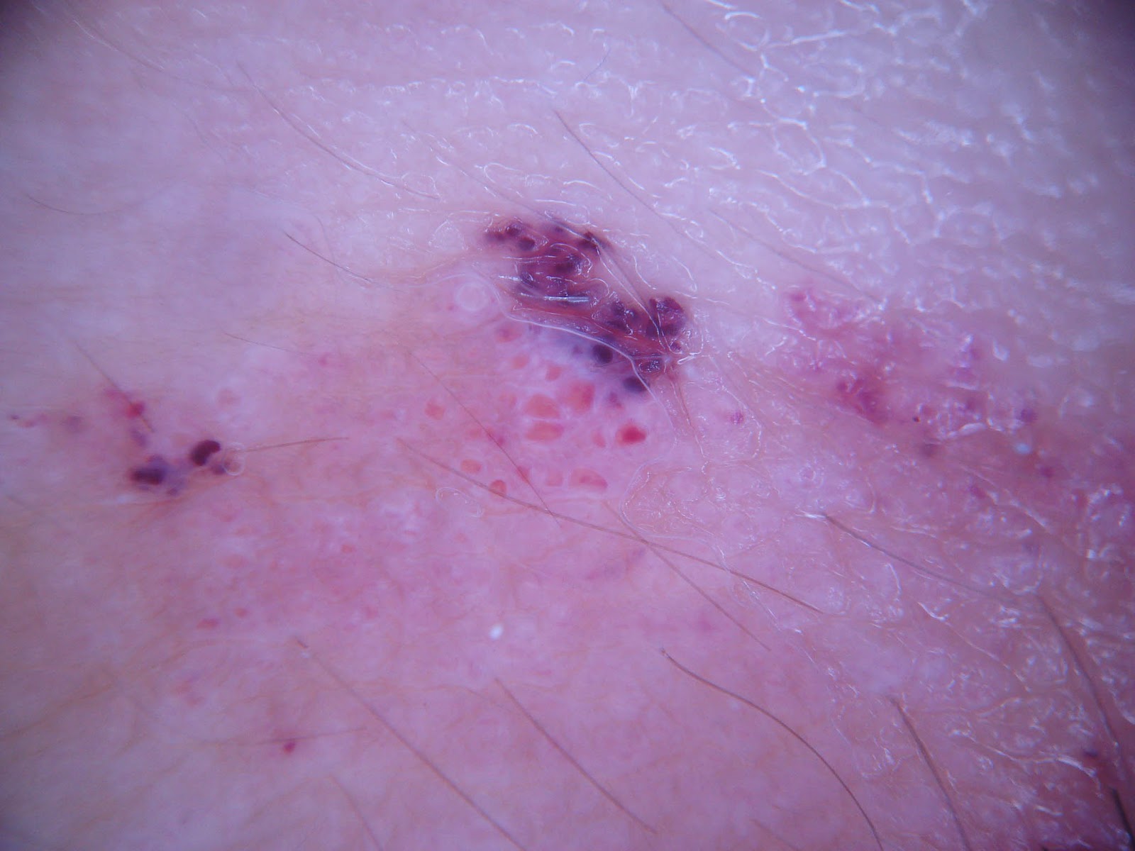 VIRTUAL GRAND ROUNDS IN DERMATOLOGY 2.0: Vascular Lesion in a Six Year-Old