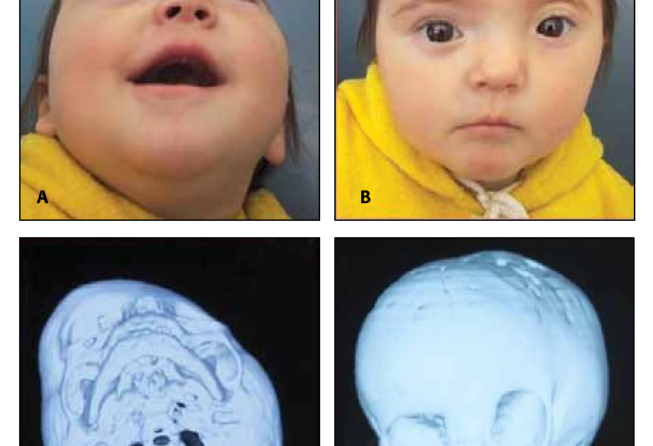 ¿Qué es la plagiocefalia? ~ Mi Bebé