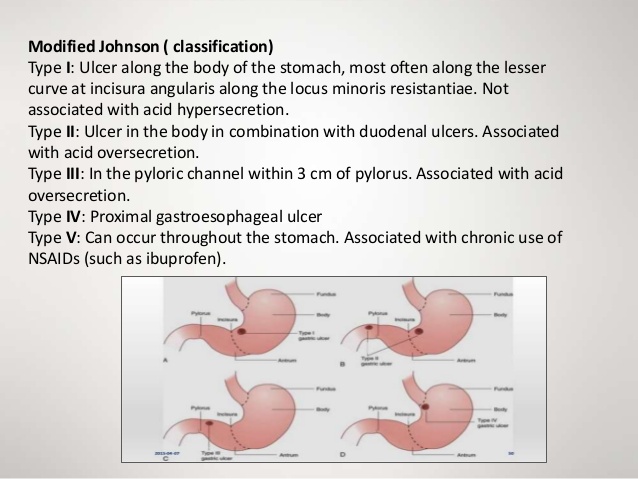 PEPTIC ULCER DISEASE