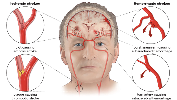 Biomedical sciences and pharmacology: Tissue Plasminogen Activator (tPA ...